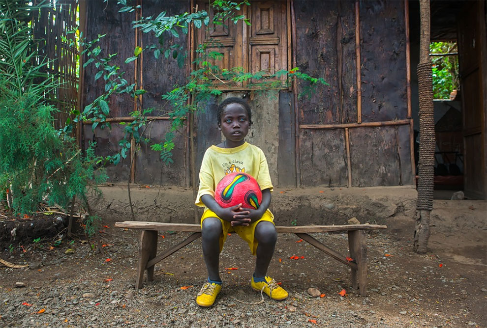 Abushe, An African Child With Plastic Eyes » Design You Trust — Design ...