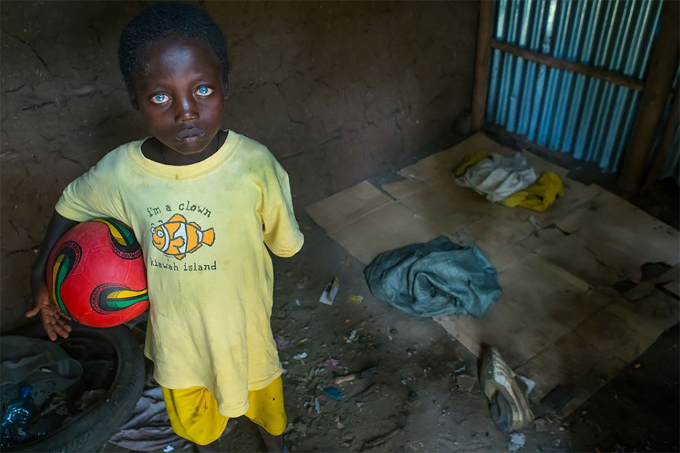Abushe, An African Child With Plastic Eyes » Design You Trust — Design ...