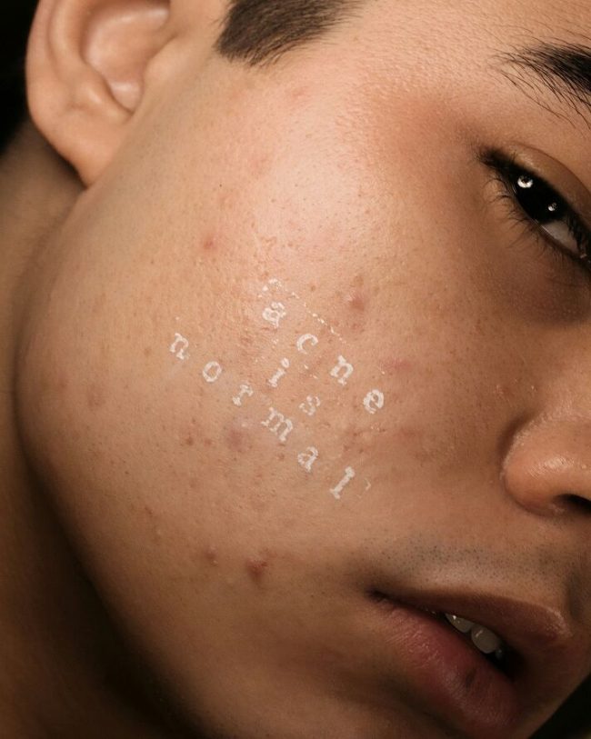 This Photographer Takes Beautiful Portraits Of People With Acne ...