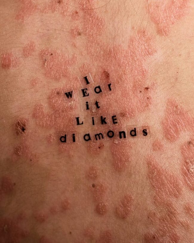 This Photographer Takes Beautiful Portraits Of People With Acne ...