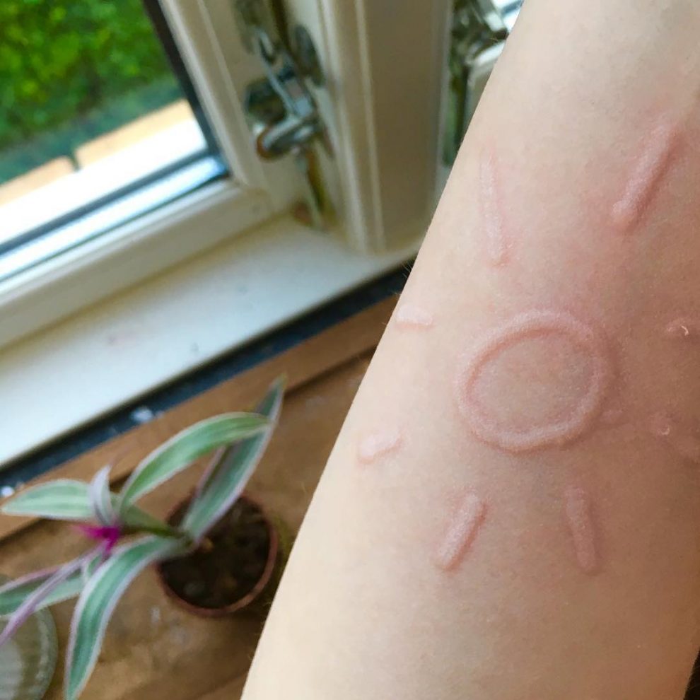 Teen Allergic to Touch Uses Her Own Body as Human Etch-a-Sketch ...