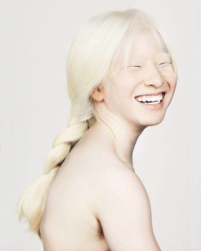Abandoned As A Baby Due To Albinism, Xueli Grew Up To Become A Vogue Model » Design You Trust ...