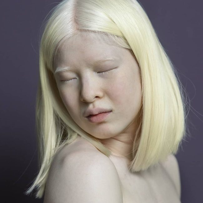 Abandoned As A Baby Due To Albinism, Xueli Grew Up To Become A Vogue ...