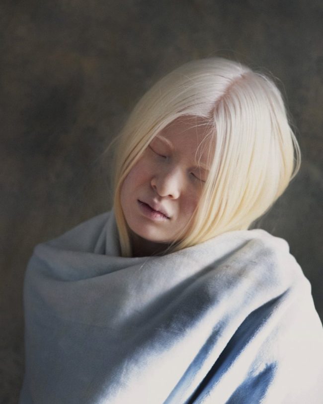 Abandoned As A Baby Due To Albinism, Xueli Grew Up To Become A Vogue ...
