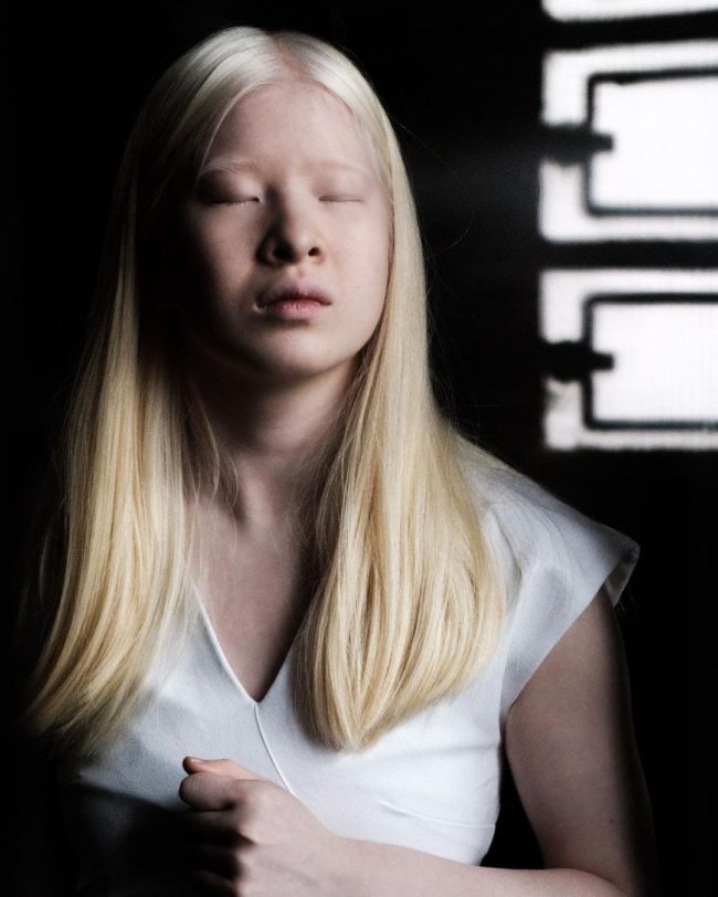 Abandoned As A Baby Due To Albinism, Xueli Grew Up To Become A Vogue ...