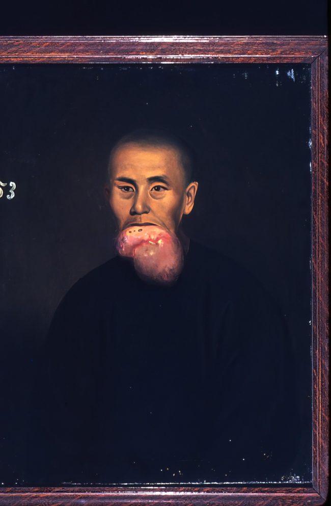 The Peter Parker Collection of Lam Qua ‘Tumor’ Bizarre Paintings ...